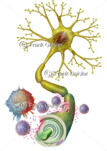 Nervenzelle, Neuron mit Multiple Sklerose der Markscheide ...
