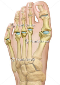 Orthopädie Fuß, Fußfehlbildung beim Spreizfuß Pes transversoplanus ...