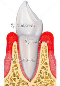 Zahnfleischentzündung, Zahn und Entzündung Zahnfleisch bei Gingivitis ...