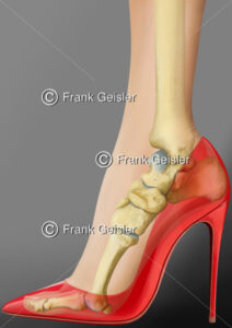 Zehen in High Heel, Anatomie Fuß mit Fußknochen vom Fußskelett ...